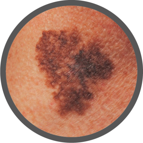 Types of Dark Spots - Meline