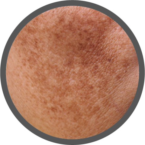 Types of Dark Spots - Meline