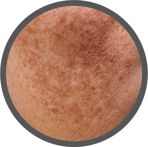 Melasma | MELINE®