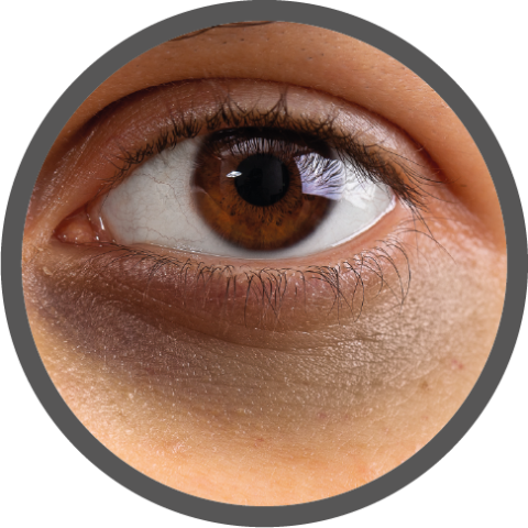 Types of Dark Spots - Meline