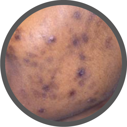 Types of Dark Spots - Meline